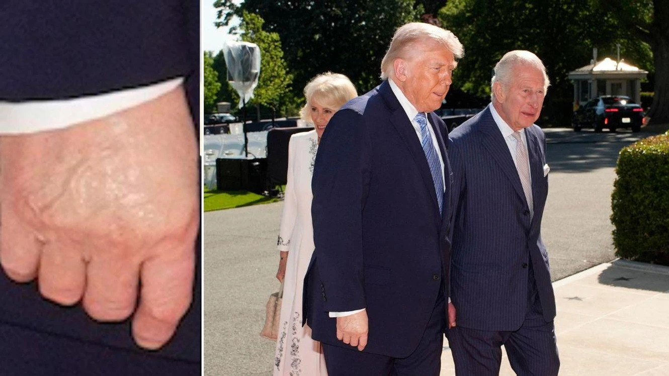 Donald Trump's swollen hands fuel health concerns during King Charles visit