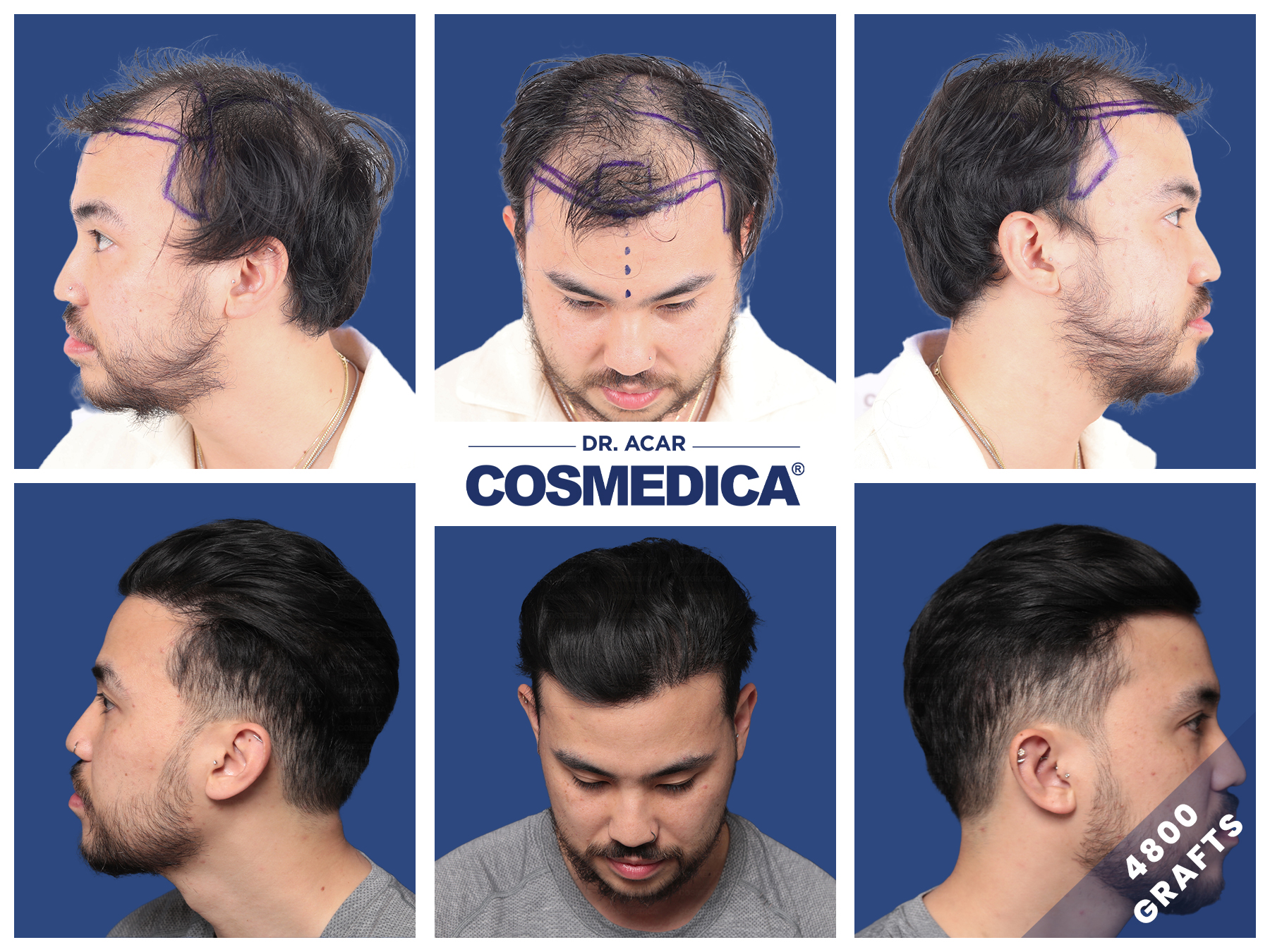 Hair transplant before and after: What looks natural?