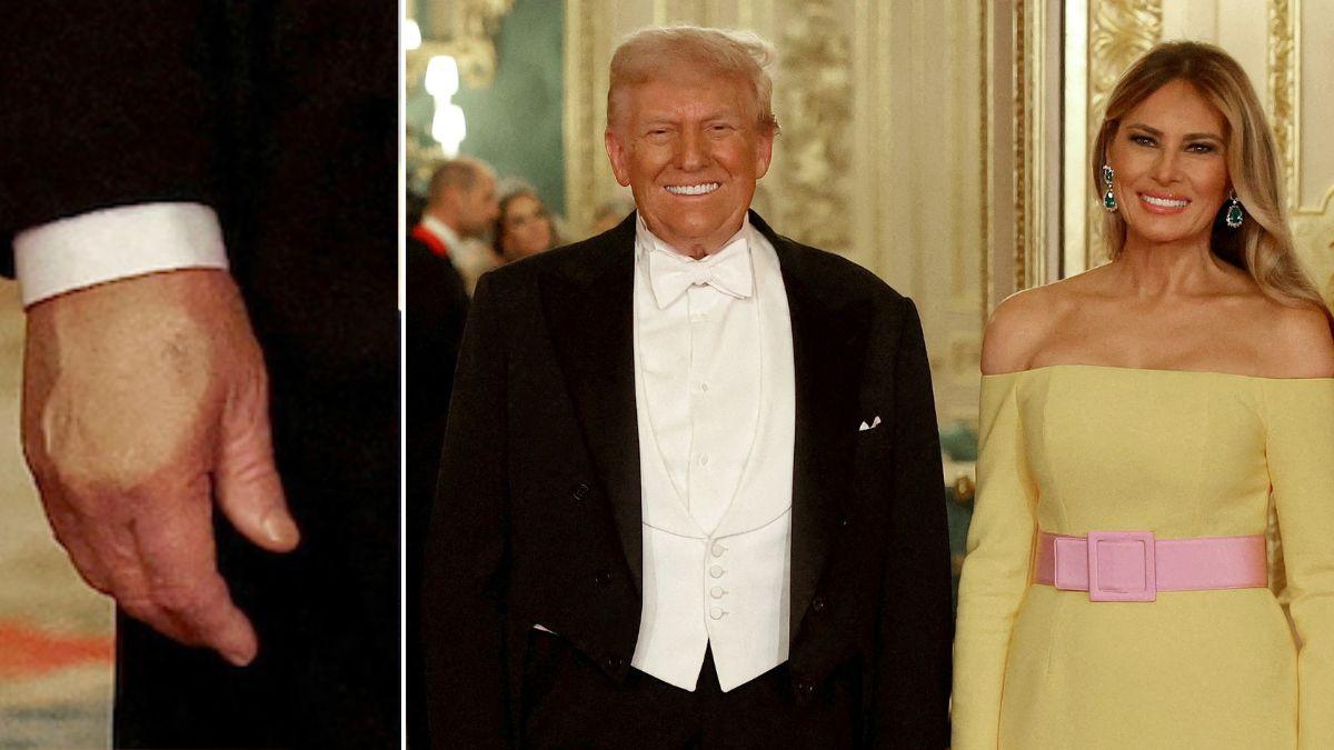 Donald Trump S Swollen Hands Fuel Health Concerns During King Charles Visit